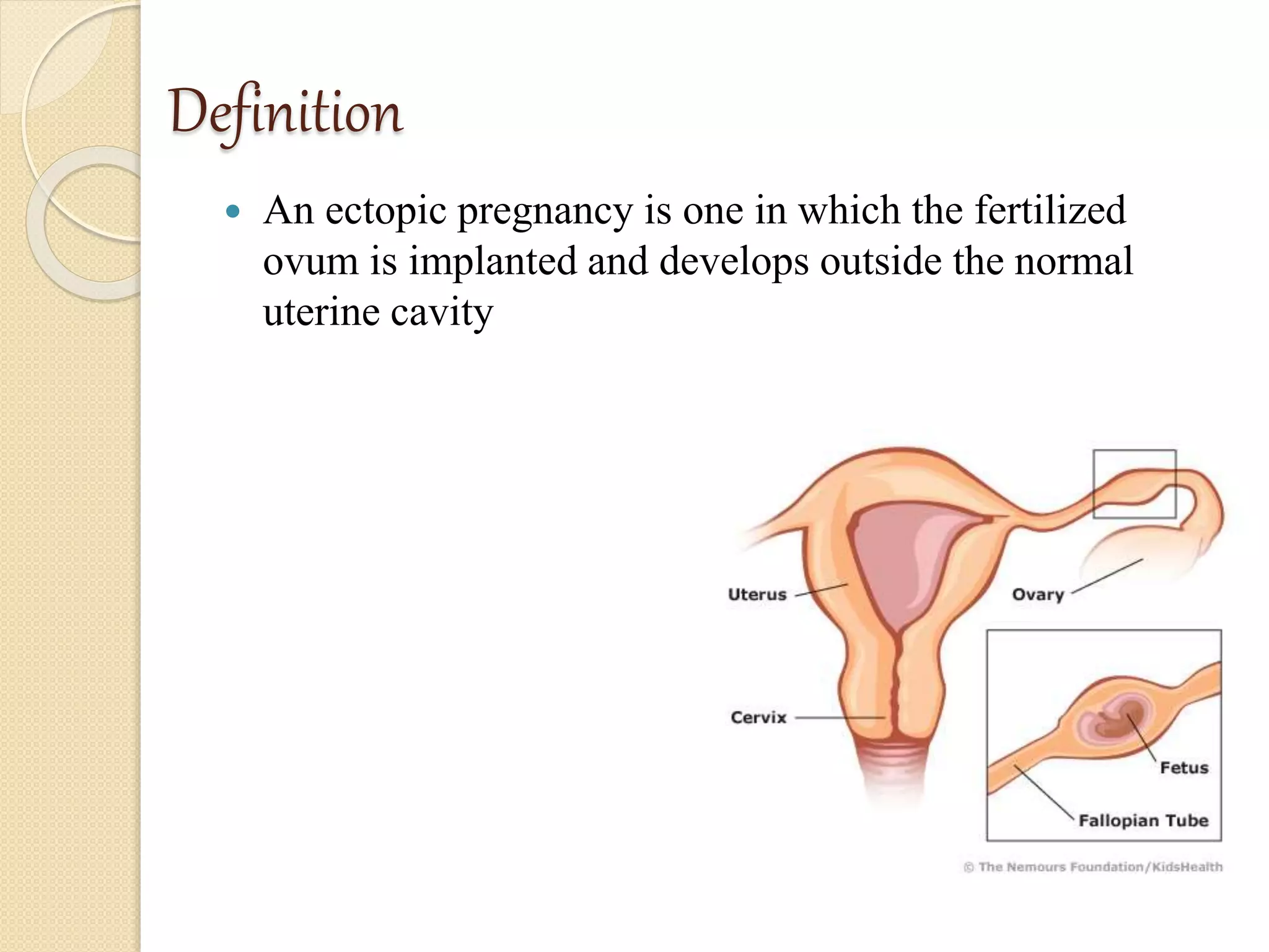 ectopic pregnancy.pptx