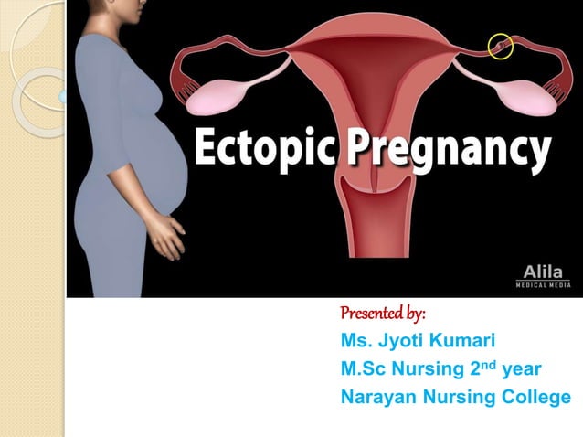 ectopic pregnancy.pptx