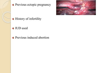 ectopic pregnancy.pptx