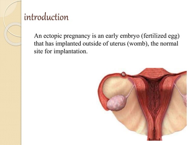 ectopic pregnancy.pptx
