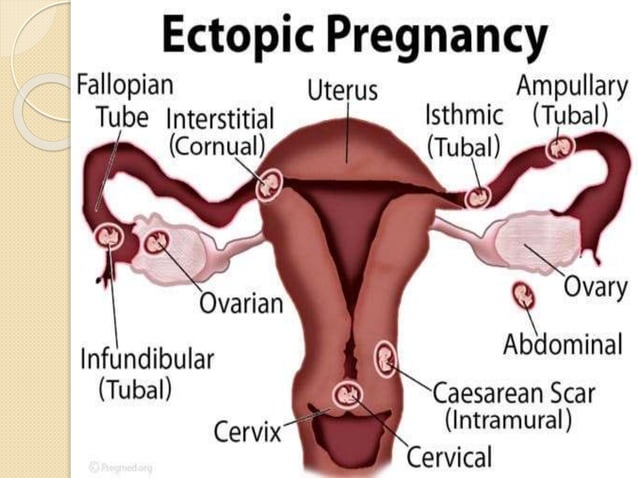 ectopic pregnancy.pptx