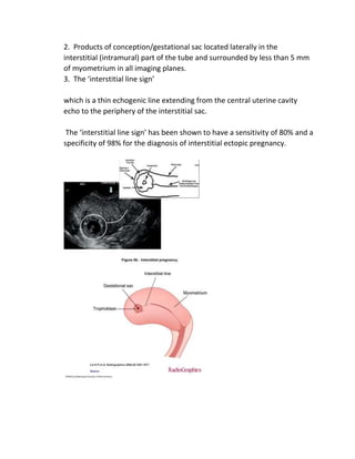 ECTOPIC PREGNANCY.docx