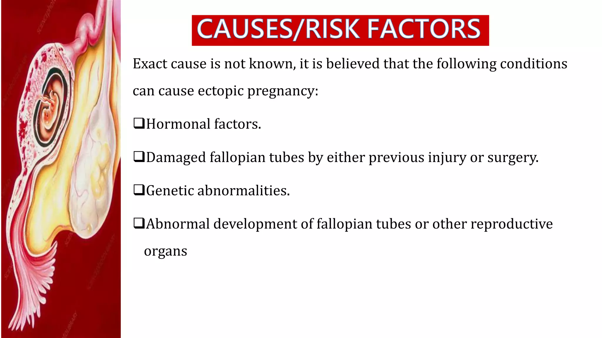 ECTOPIC PREGNANCY.pptx