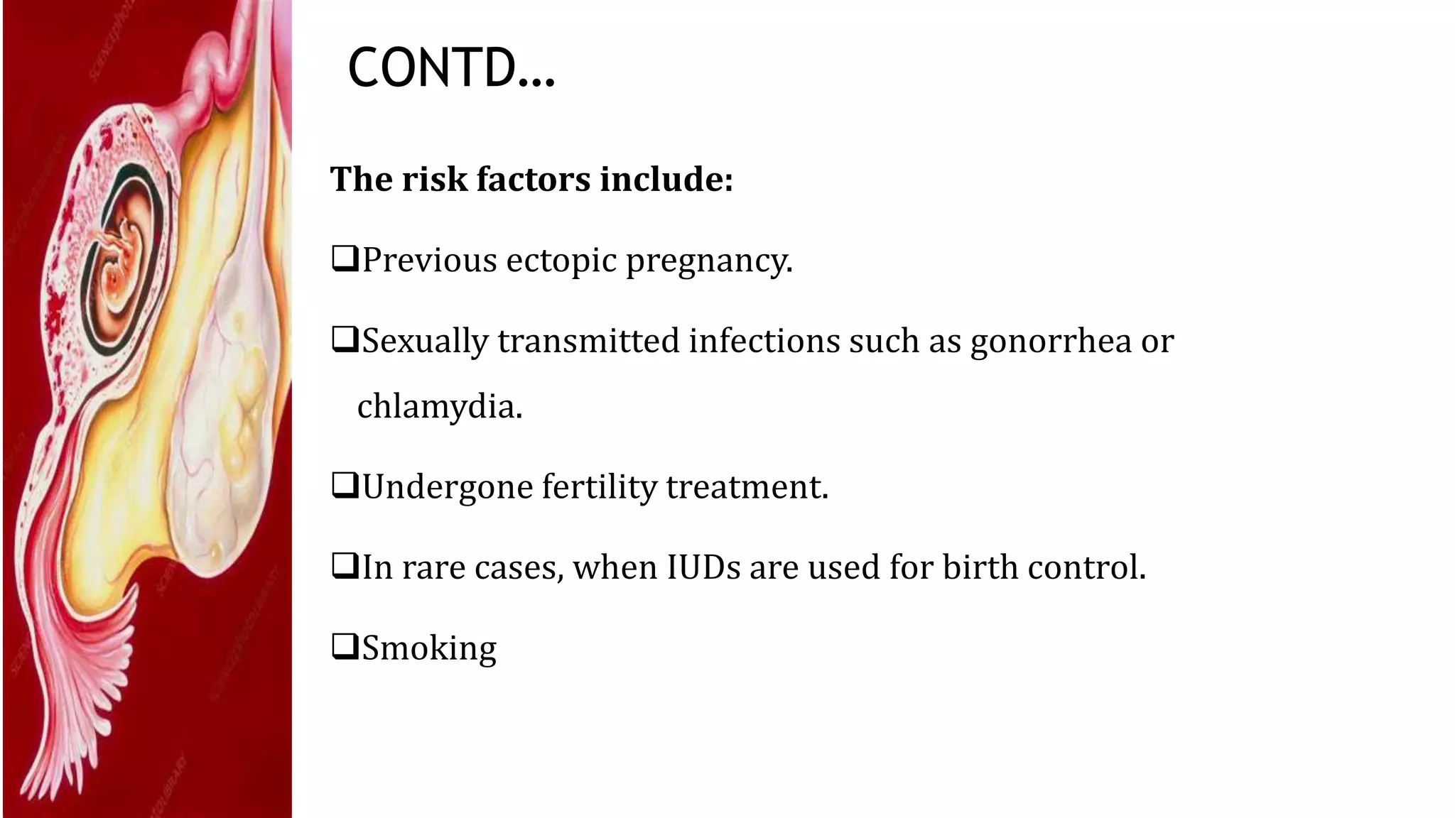 ECTOPIC PREGNANCY.pptx