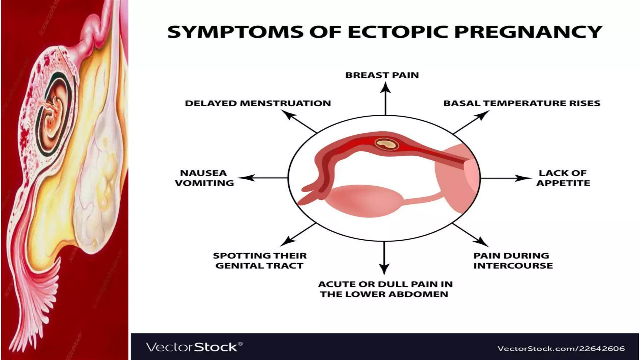 ECTOPIC PREGNANCY.pptx