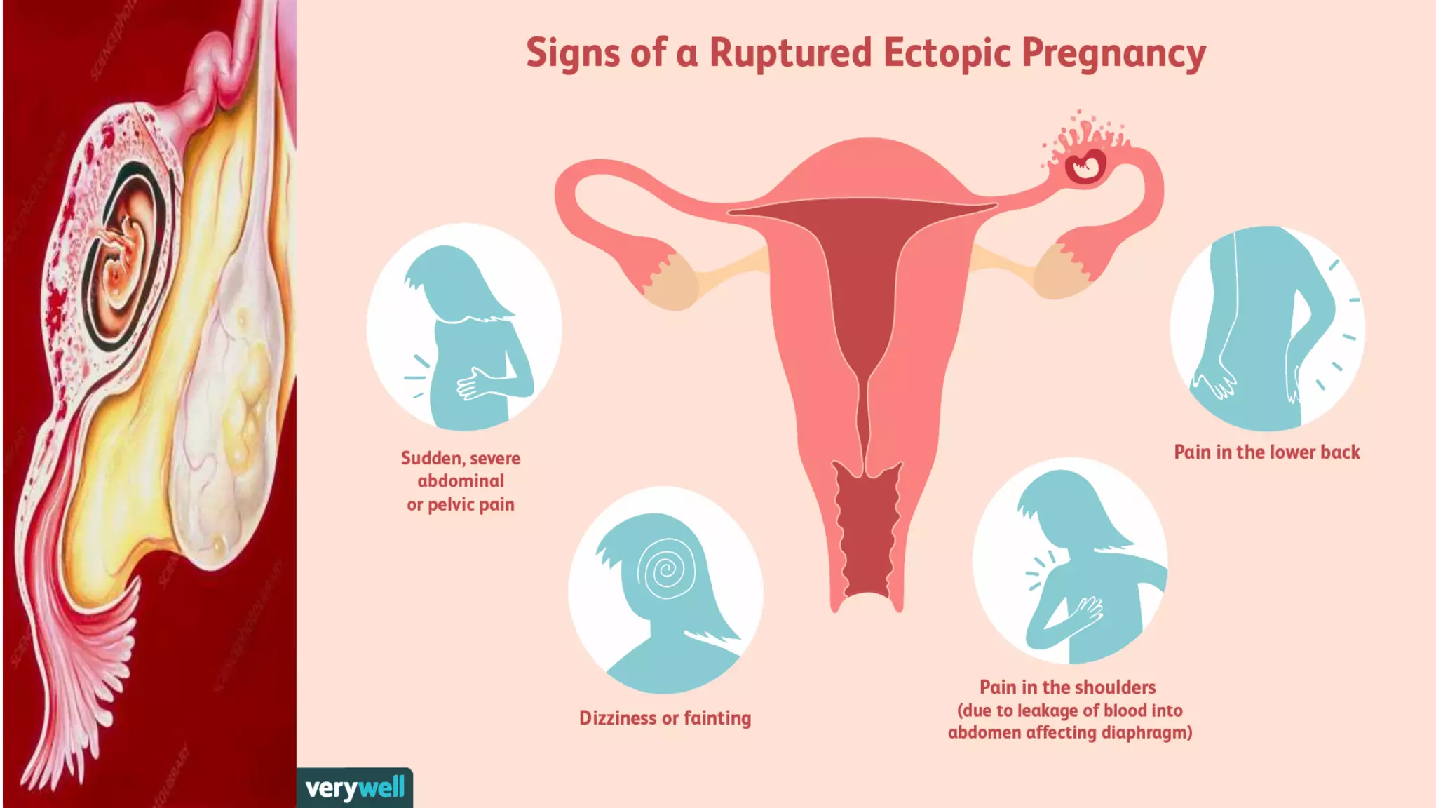 ECTOPIC PREGNANCY.pptx