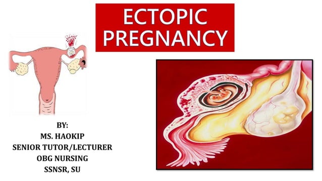 ECTOPIC PREGNANCY.pptx