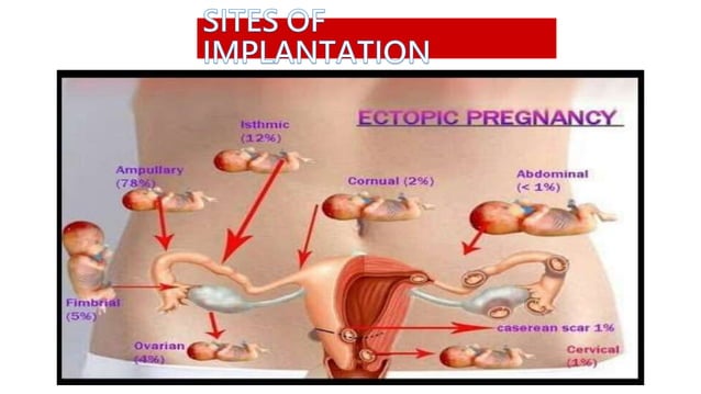 ECTOPIC PREGNANCY.pptx
