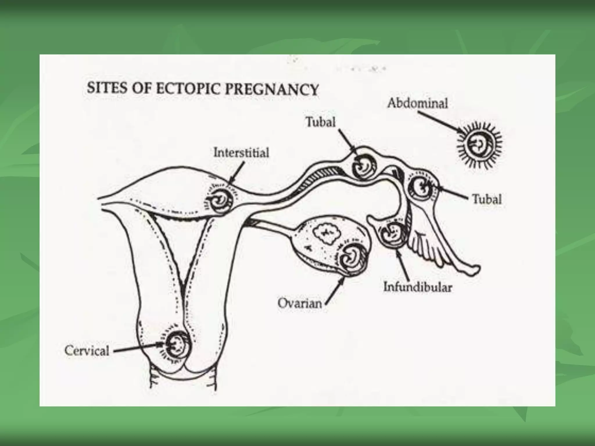 ectopic pregnancy.ppt