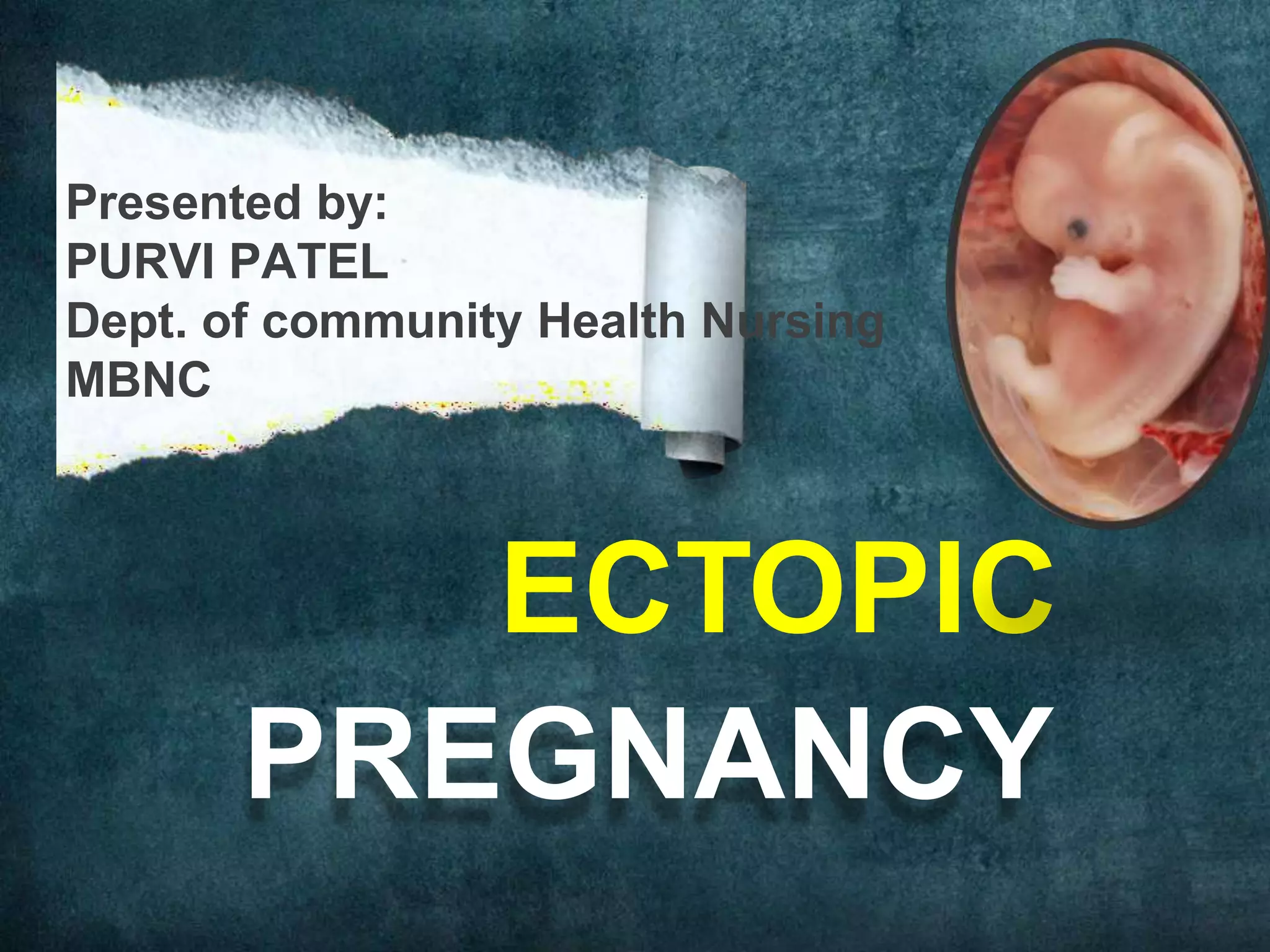 ECTOPIC PREGNANCY.pptx