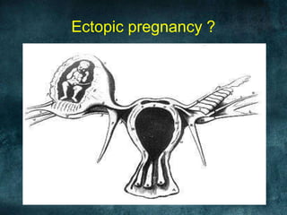 ECTOPIC PREGNANCY.pptx