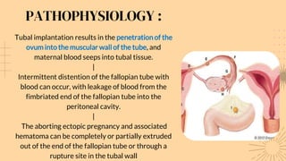 Ectopic pregnancy.pptx