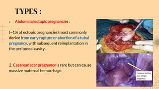 Ectopic pregnancy.pptx