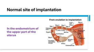 ectopic pregnancy (tubal ectopic pregnancy).pdf