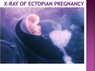 ectopic pregnancy in obstetric and gyanaecology | PPTX
