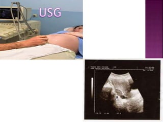 ectopic pregnancy in obstetric and gyanaecology | PPTX