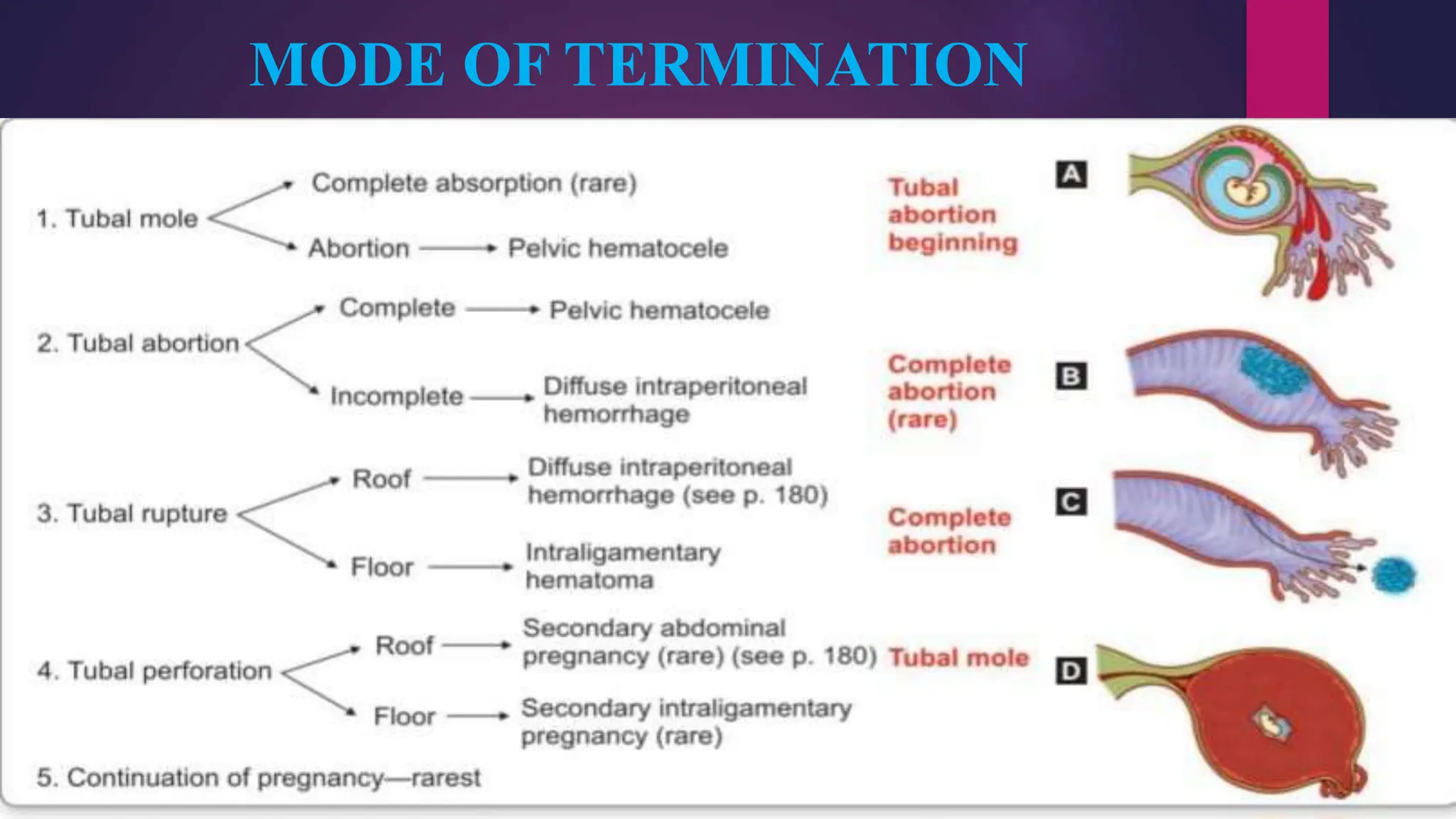 ECTOPIC PREGNANCY obstetrics and gynaecological nursing | PPTX