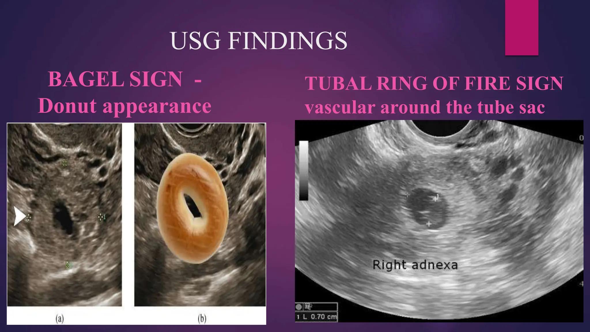 ECTOPIC PREGNANCY obstetrics and gynaecological nursing | PPTX