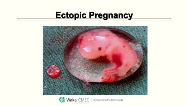 Ectopic pregnancy.pptx