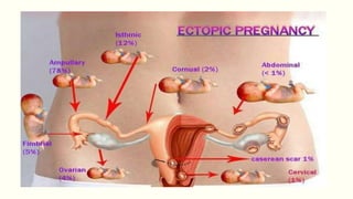 Ectopic pregnancy.pptx
