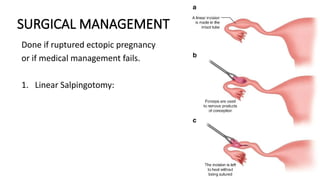 ectopic pregnancy presentation for obs and gyne | PPTX