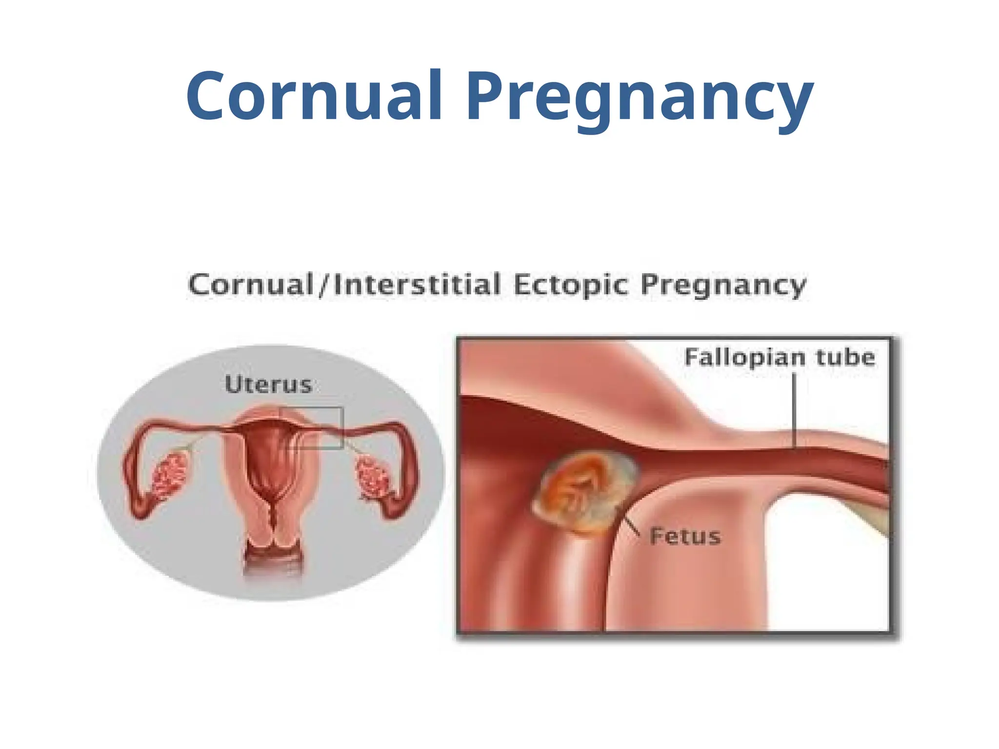 Powerpoint presentation Ectopic Pregnancy.pptx