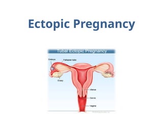 Powerpoint presentation Ectopic Pregnancy.pptx