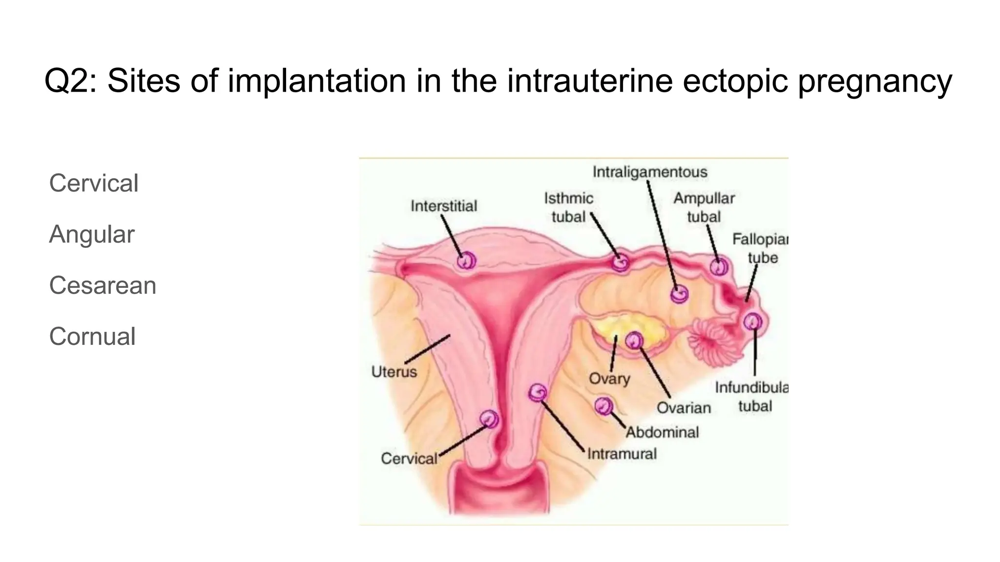 ECTOPIC PREGNANCY lecture for MBBS .pptx