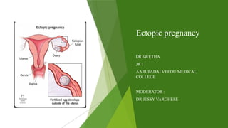 ectopic pregnancy power point presentation | PPTX