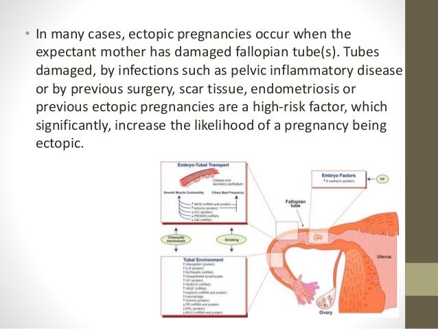 Ectopic Pregnancy - A Better Understanding
