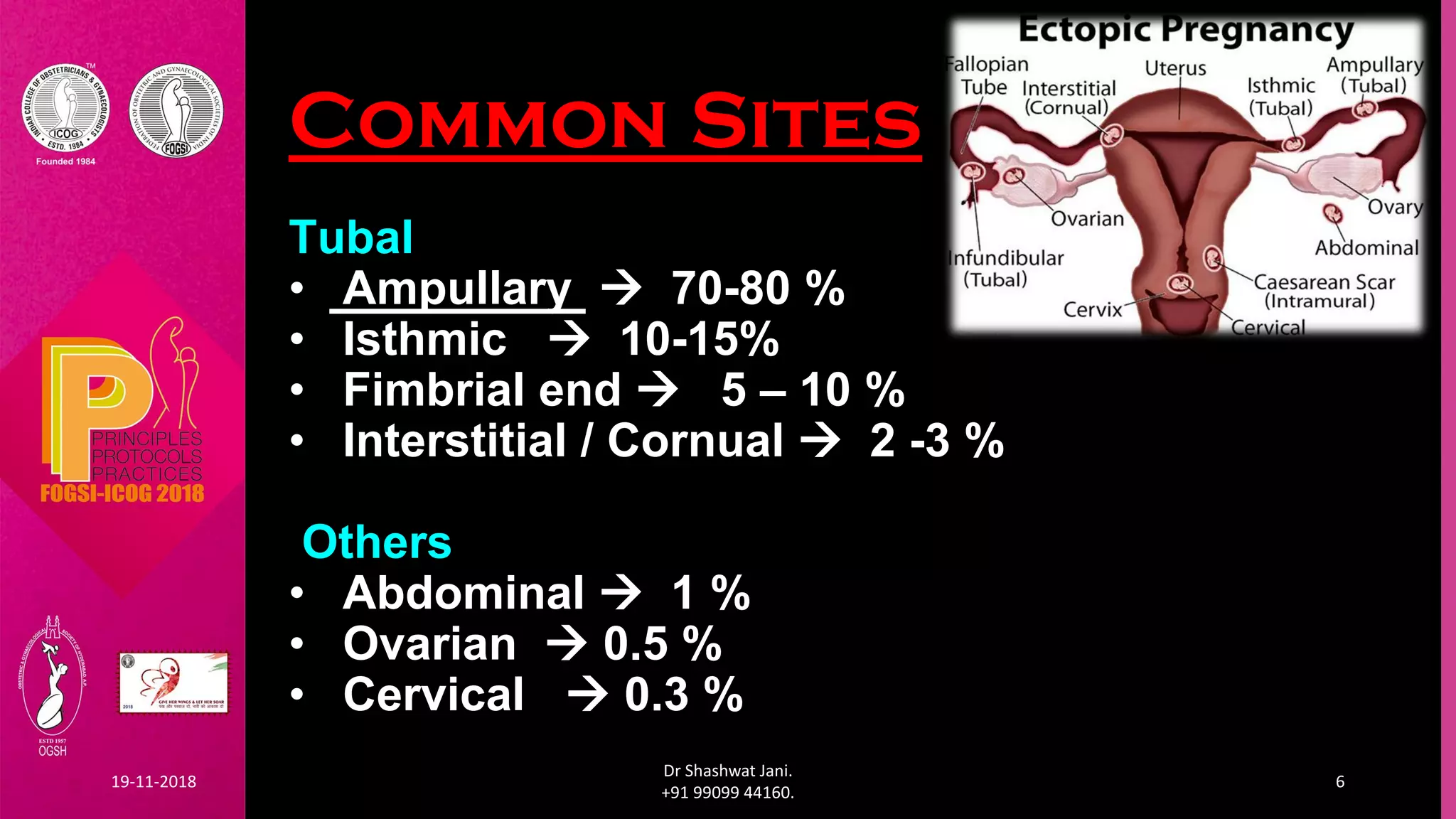 ECTOPIC PREGNANCY - FOGSI GUIDELINES BY DR SHASHWAT JANI | PDF