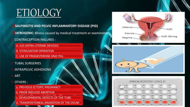 Ectopicpregnancy (1) | PPT