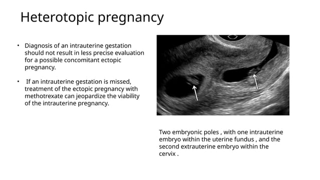 Ectopic pregnancy (1).pptc.powerpoint presentation | PPT