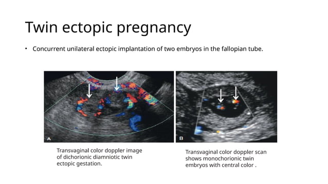 Ectopic pregnancy (1).pptc.powerpoint presentation | PPT