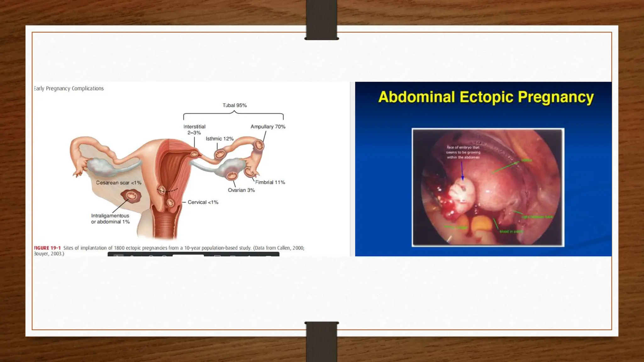 ectopic pregnancy MANAGEMENT .pptx