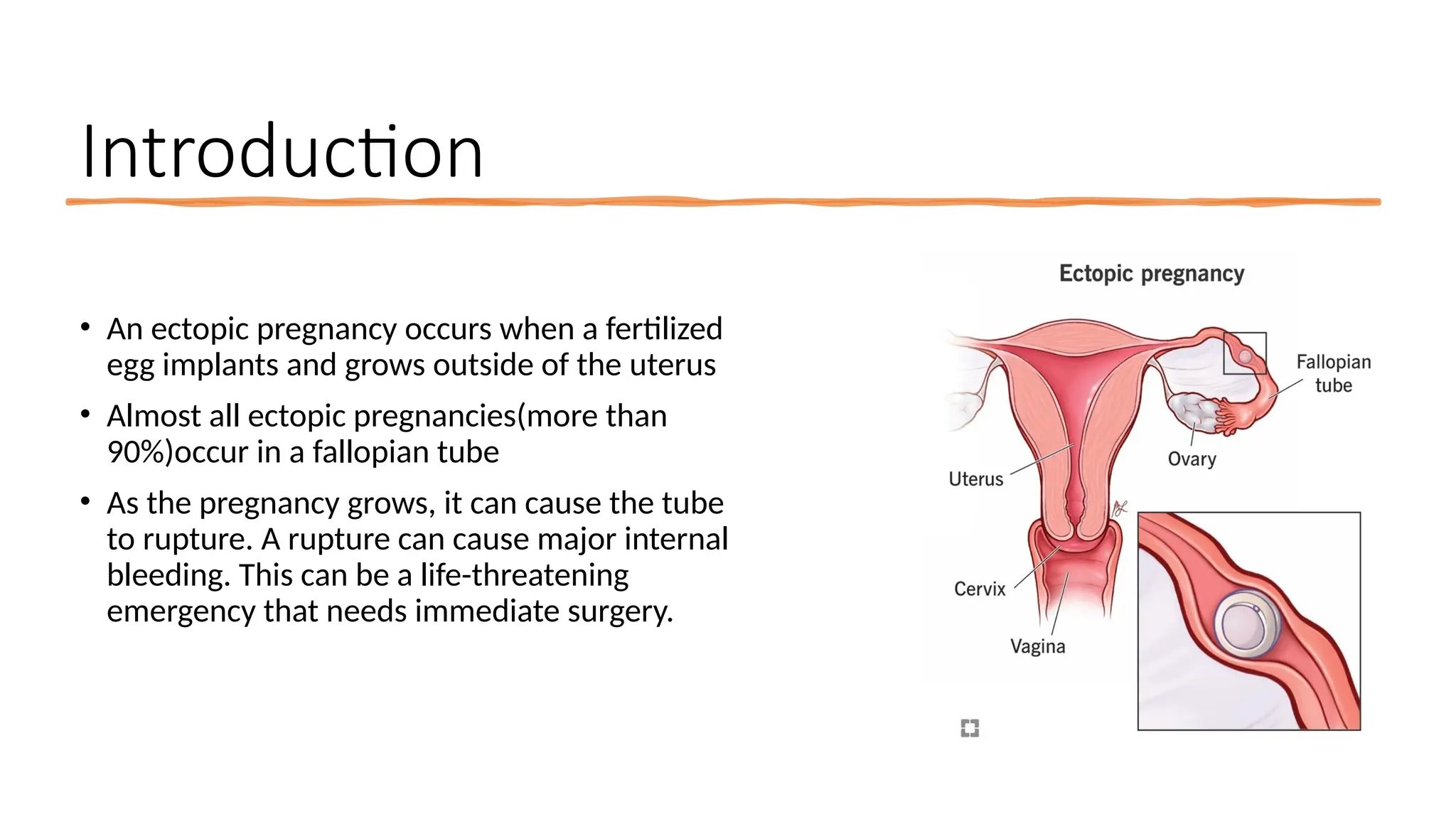 Ectopic PregnancyTGDGBGGDNBDHNH (3).ppt,,,x | PPTX