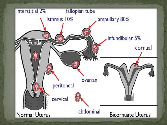 Ectopic pregnancy
