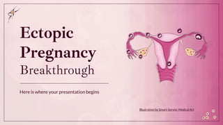 Ectopic Pregnancy Breakthrough by Slidesgo.pptx
