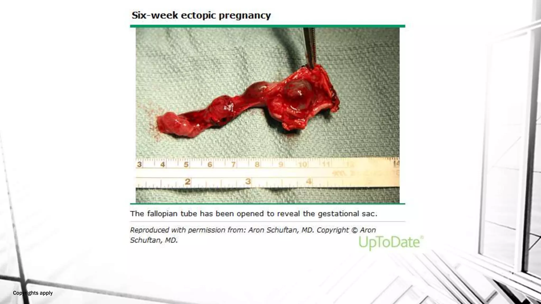 Ectopic pregnancy (EP) | PPT