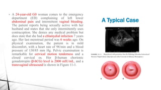 Ectopic pregnancy (EP) | PPT