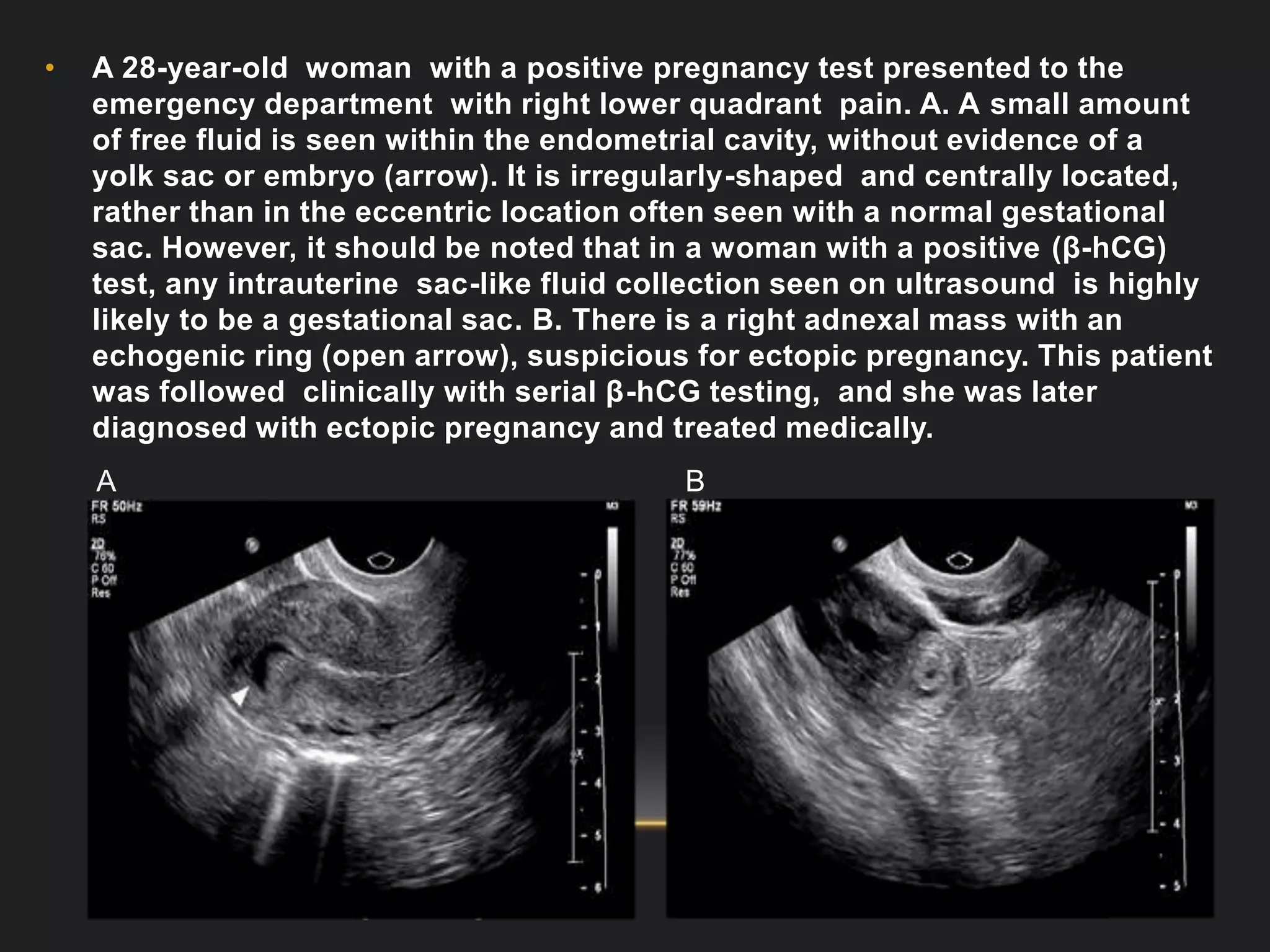 Ectopic pregnancy by sarah aboelsoud | PPTX