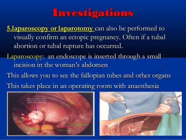 Ectopic pregnancy