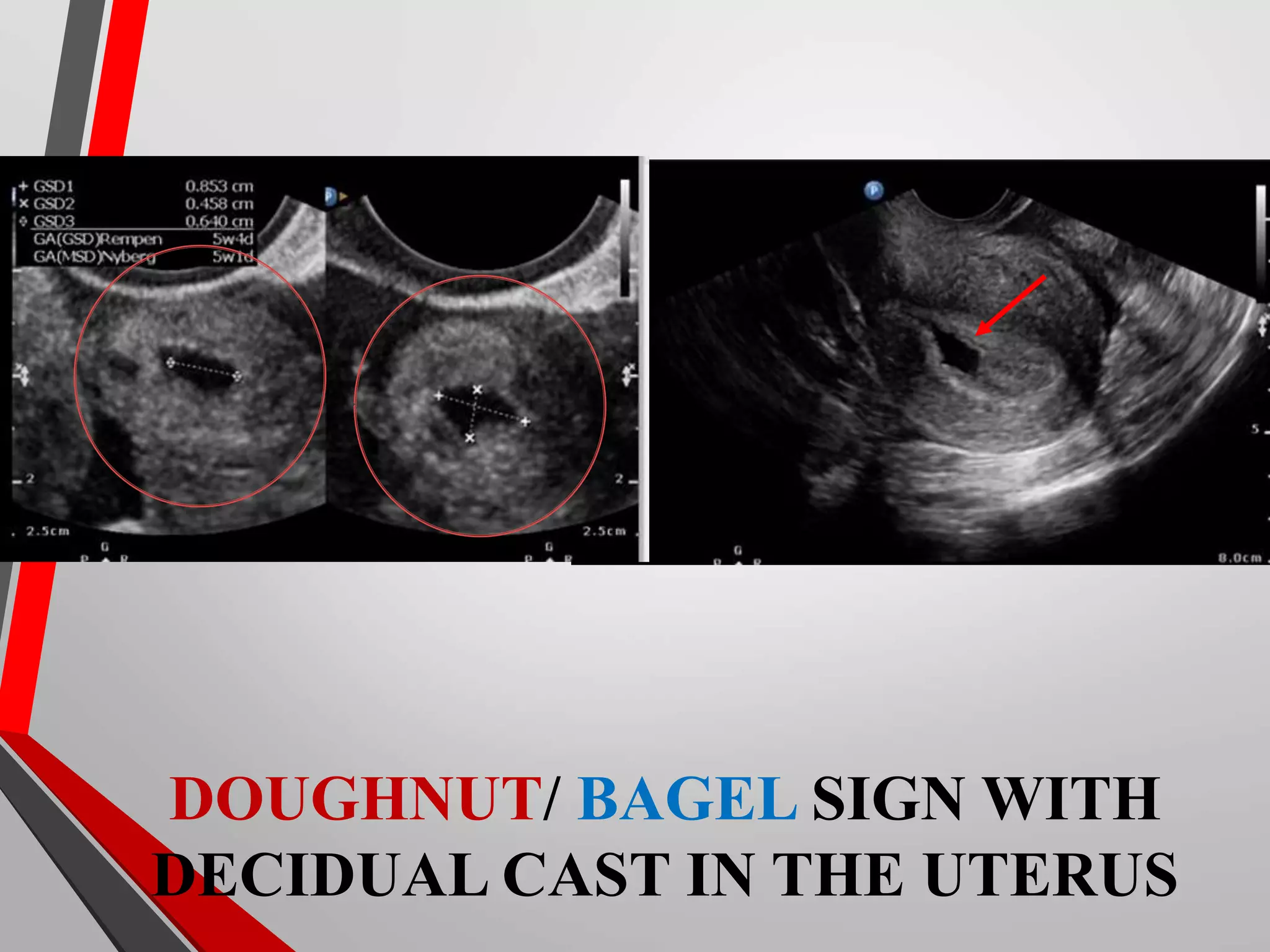 Ectopic pregnancy Radiology | PPTX