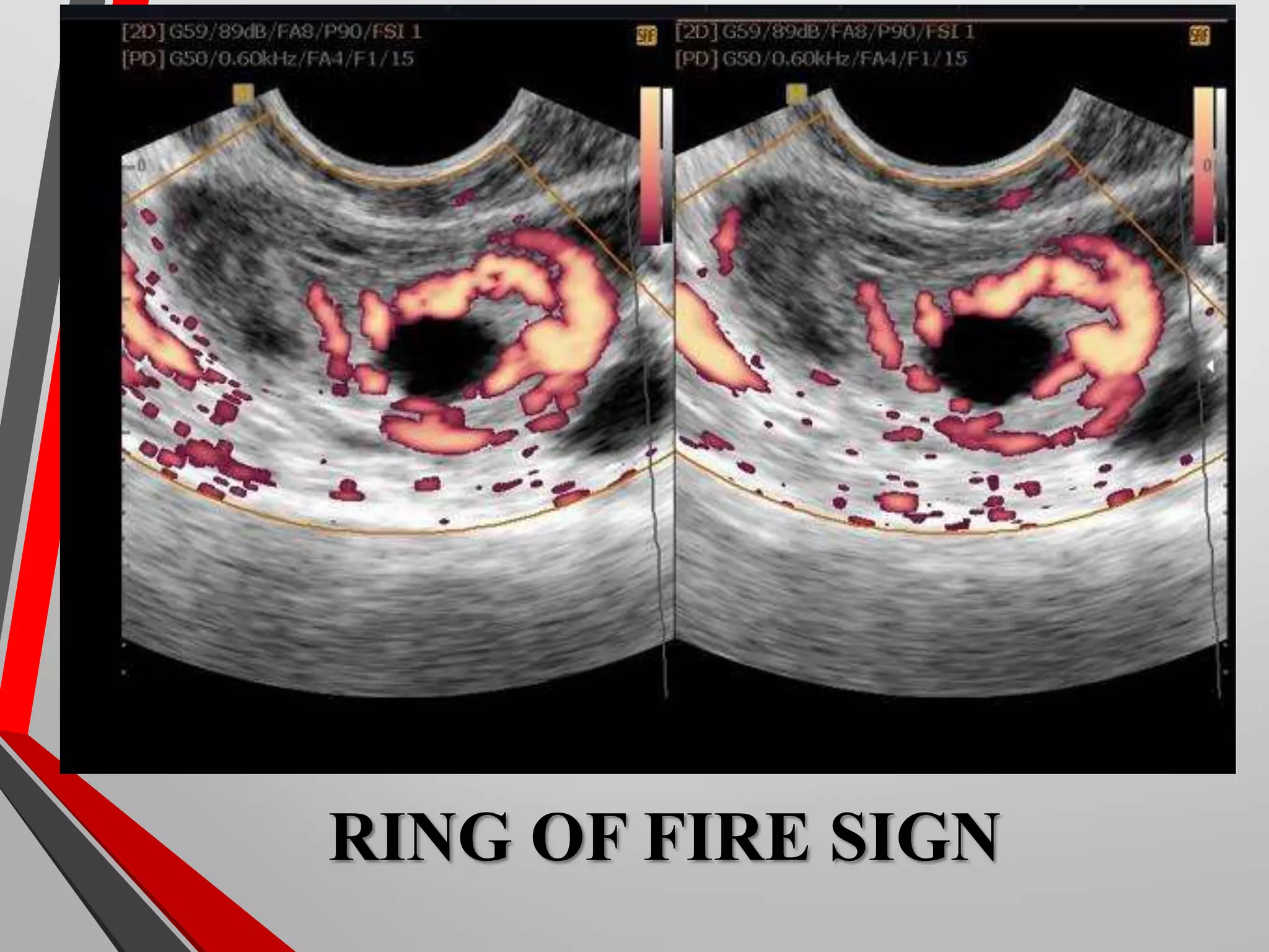 Ectopic pregnancy Radiology | PPTX