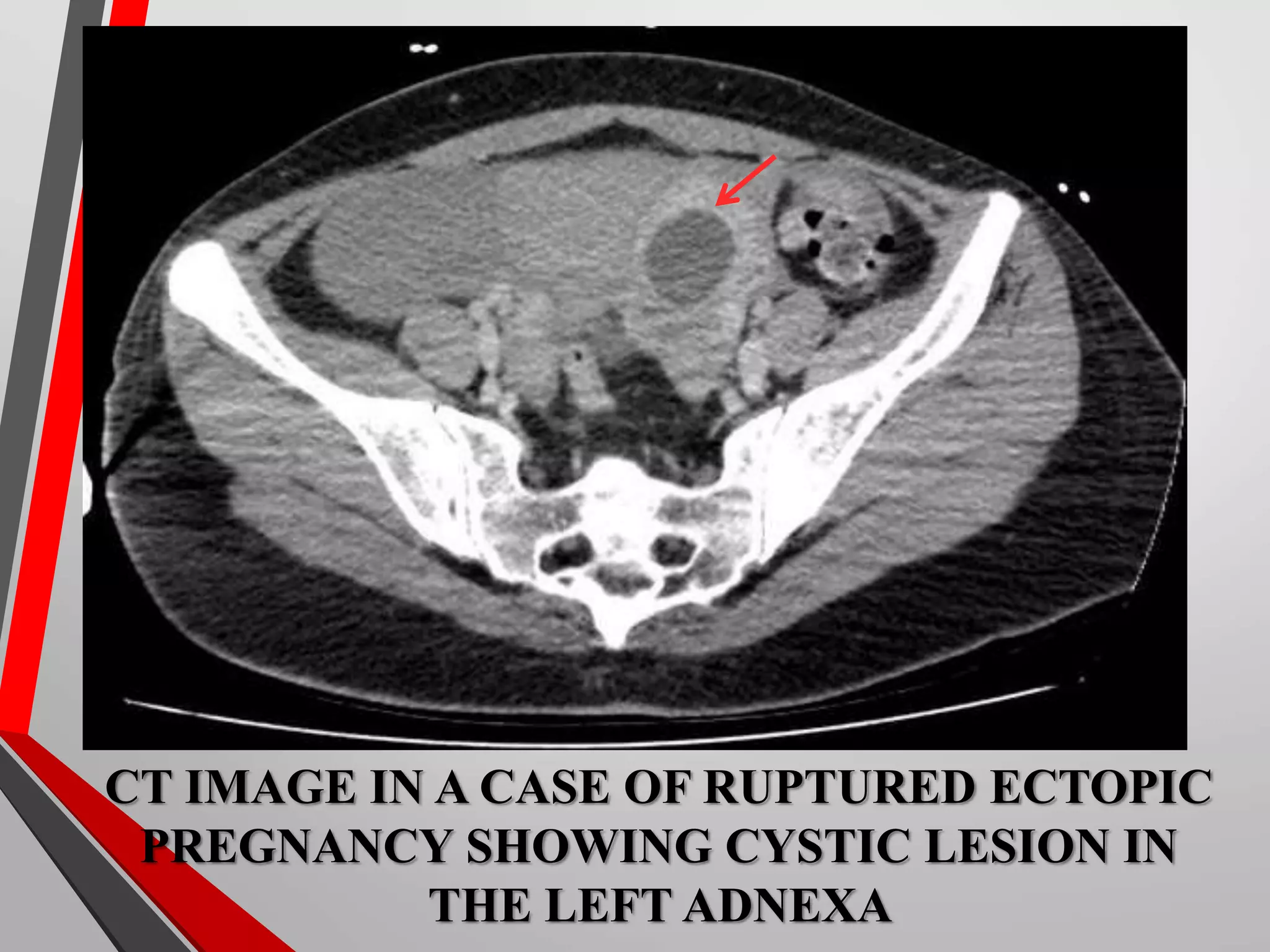 Ectopic pregnancy Radiology | PPTX
