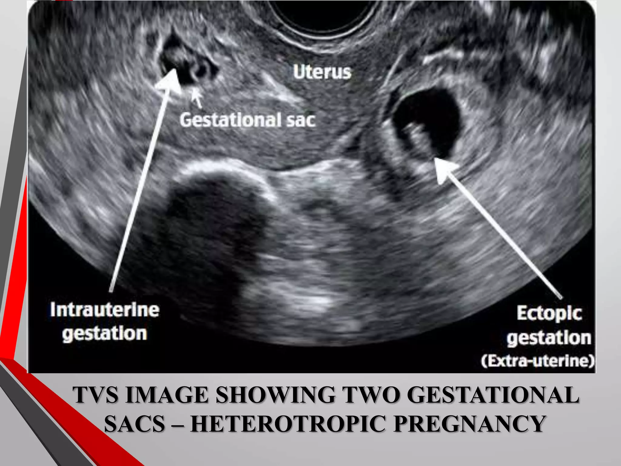 Ectopic pregnancy Radiology | PPTX