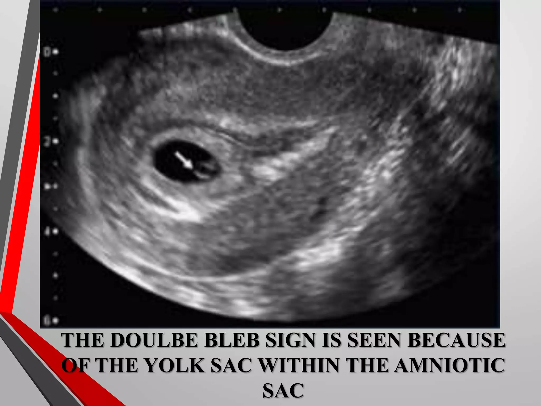 Ectopic pregnancy Radiology | PPTX