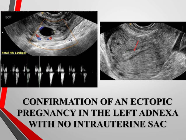 Ectopic Pregnancy Radiology Ppt