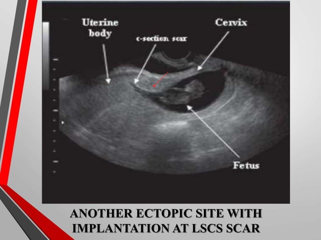 Ectopic pregnancy Radiology | PPTX