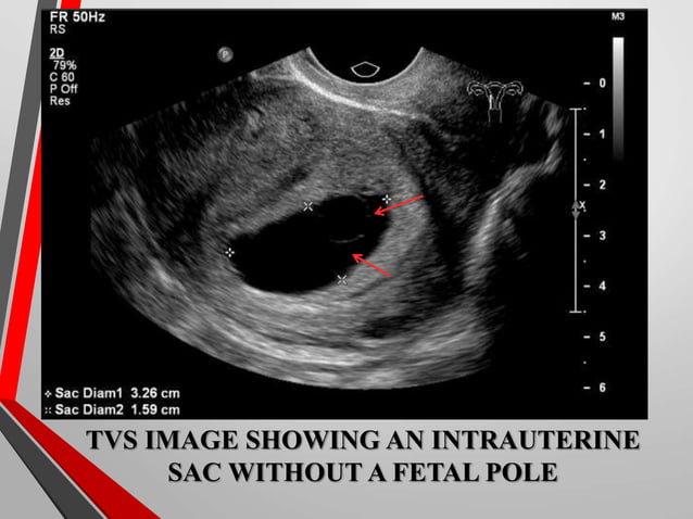 Ectopic pregnancy Radiology | PPTX